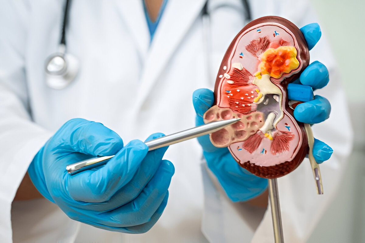 Progression of Kidney Disease | Stages & How to Slow It Down